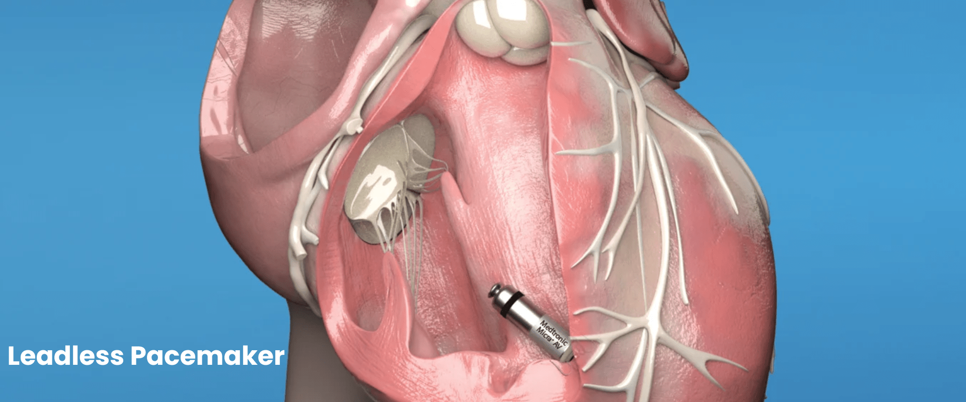 Leadless Pacemaker | Wireless Heart Rytm Solution